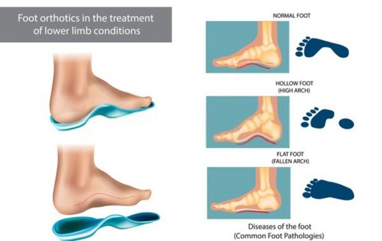 Arch Support and Why You Should Wear Them?