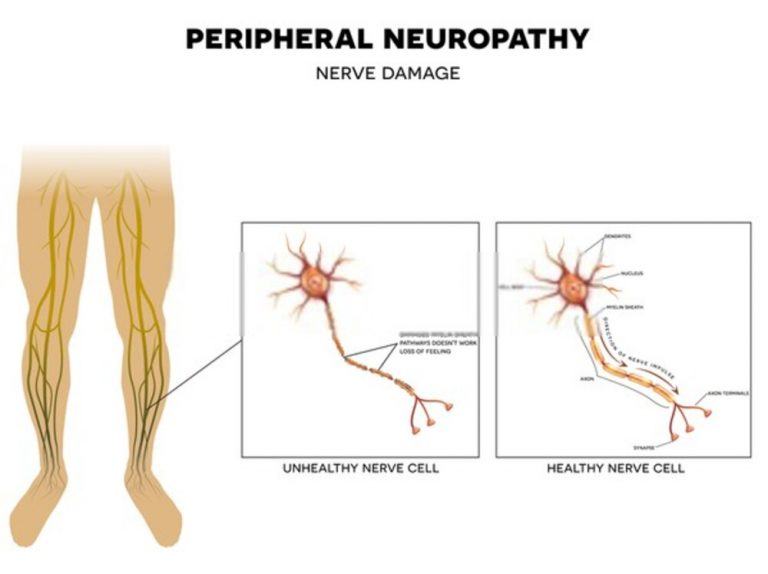 Upper Thigh Pain When Walking: Causes, Types and More - Hood MWR