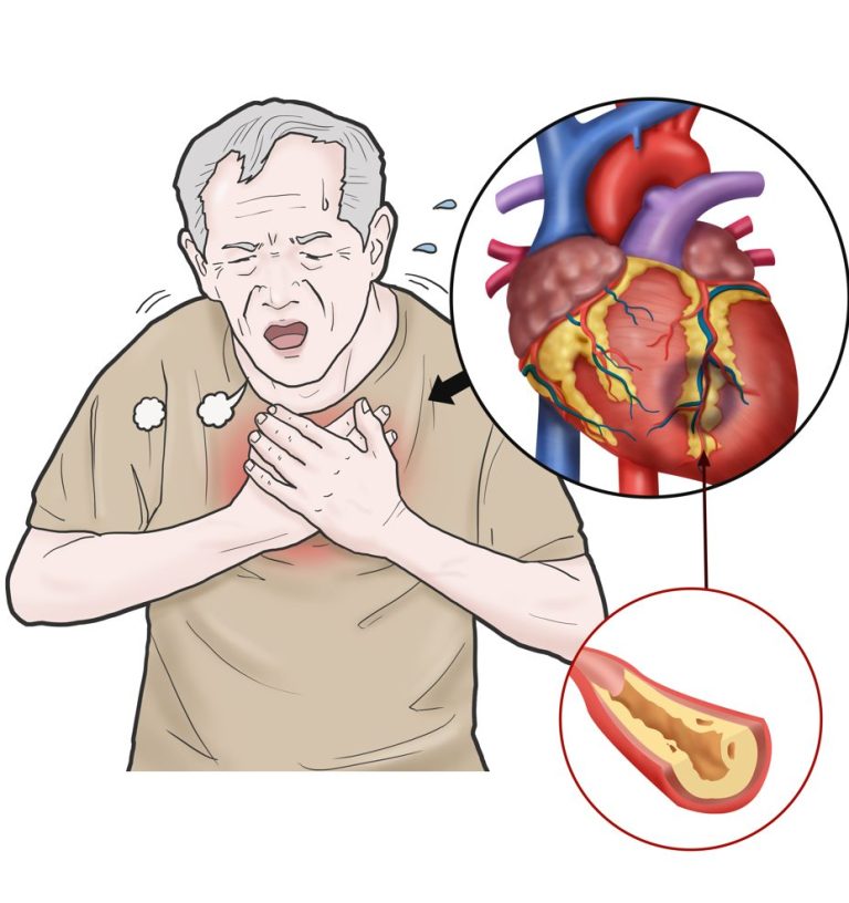 Why Walking Causes Chest Pain: Possible Reasons and Preventions - Hood MWR