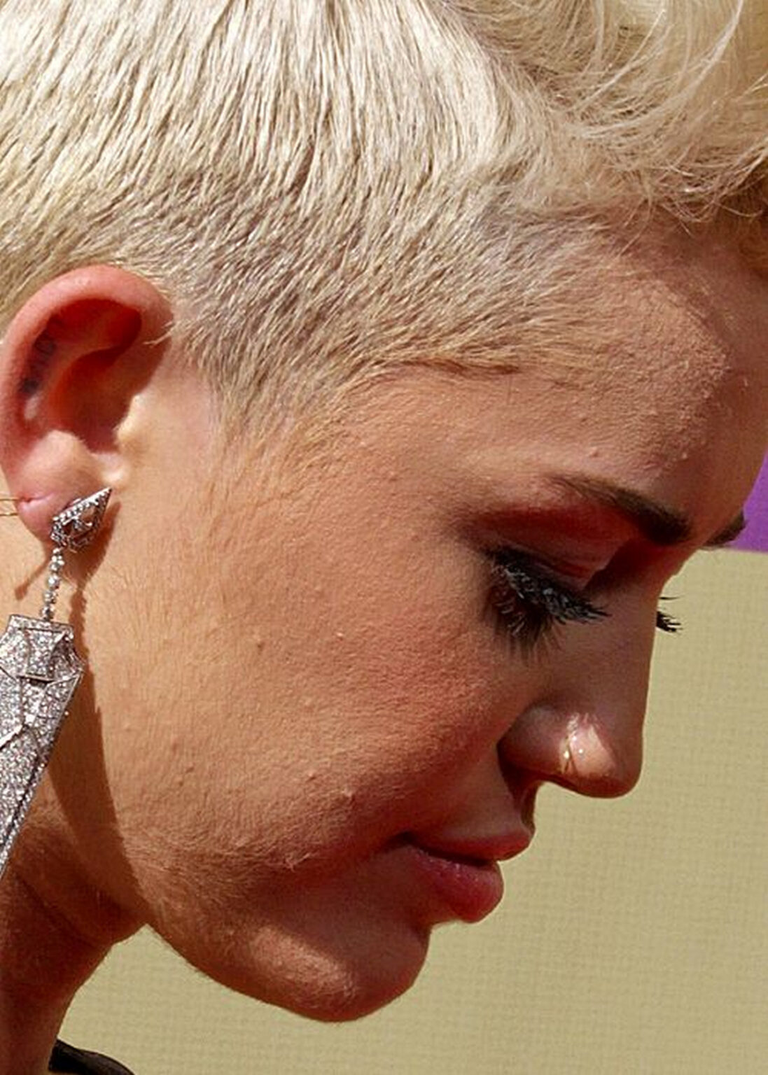 50 Celebrities Who Have Suffered From Acne - Hood MWR