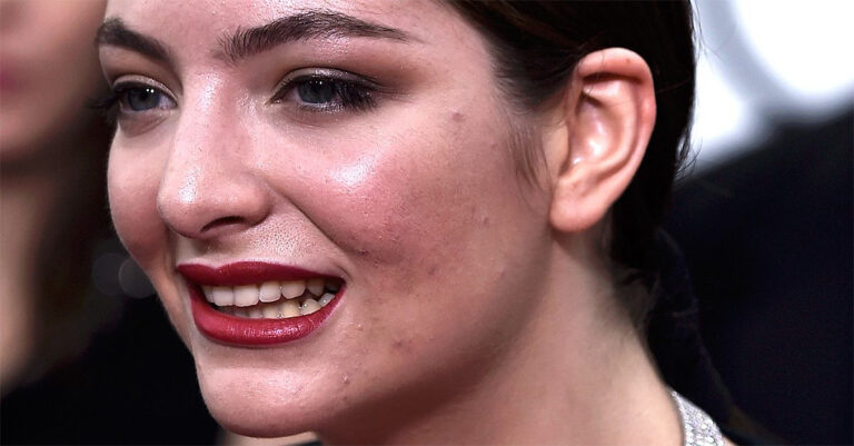 50 Celebrities Who Have Suffered From Acne - Hood MWR