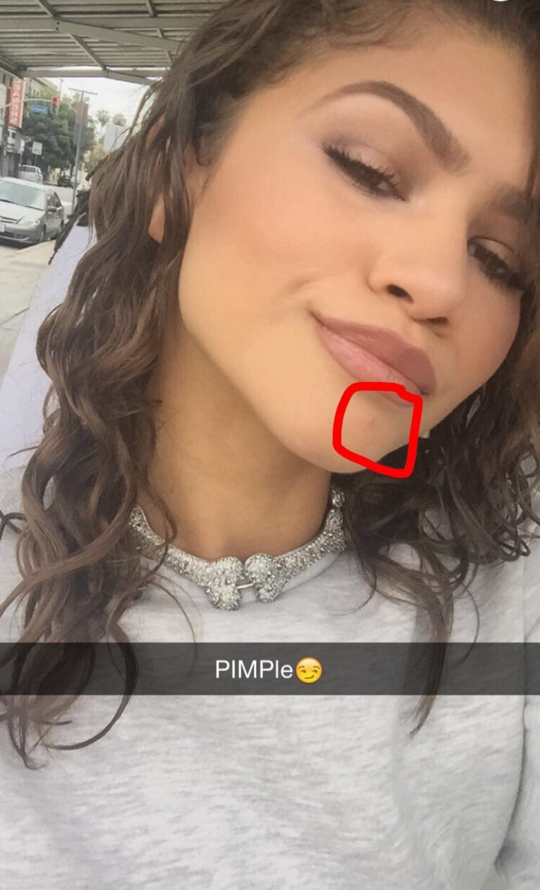 50 Celebrities Who Have Suffered From Acne - Hood MWR