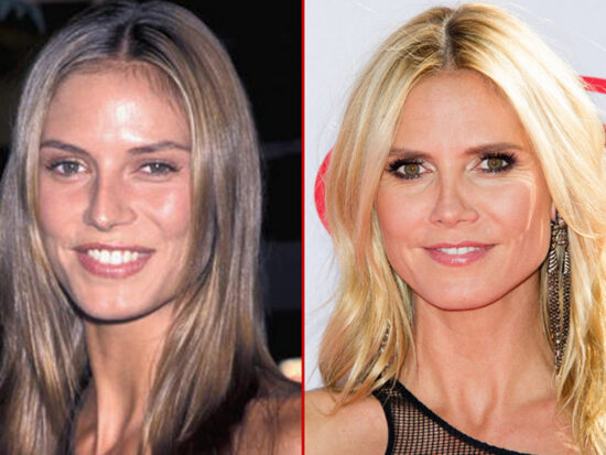 50 Celebrities Who Have Gotten a Thread Lift - Hood MWR