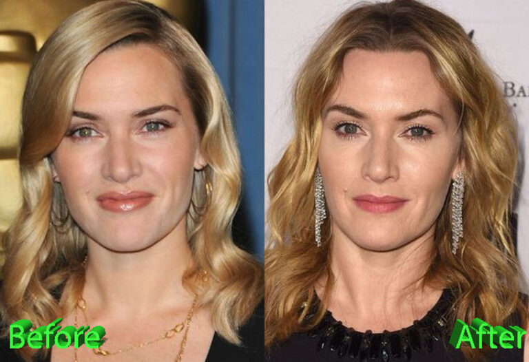 50 Celebrities Who Have Gotten a Thread Lift - Hood MWR