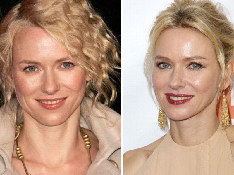 50 Celebrities Who Have Gotten a Thread Lift - Hood MWR