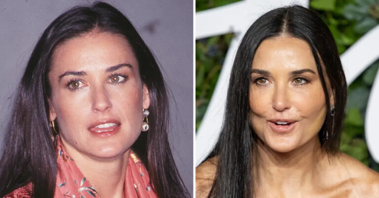50 Celebrities Who Have Gotten a Thread Lift - Hood MWR