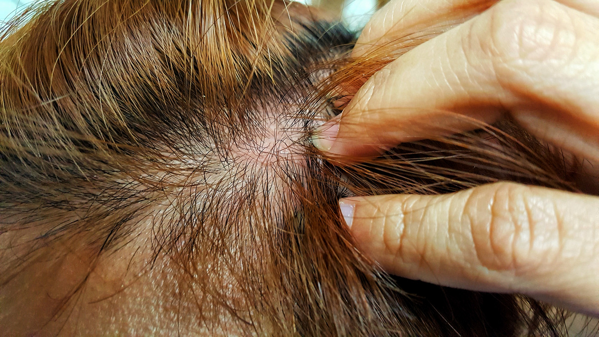 Does Your Scalp Itch When Your Hair Is Growing?